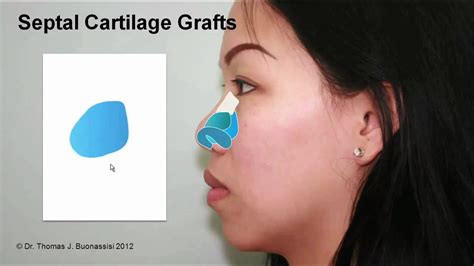 Septal Cartilage