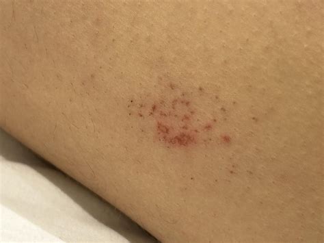 Inner Thigh Rash Itches What Is It Rdermatologyquestions