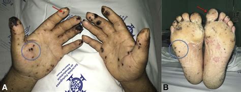 Hallmark Cutaneous Signs Of Infective Endocarditis Journal Of