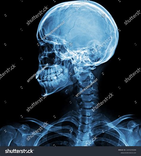 Skull Lateral View X Ray Stock Photo Shutterstock