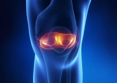 Meniscal Root Tear Torn Meniscus Root Orthopedic Knee Specialist