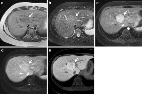 Inflammatory Hepatocellular Adenoma With β Catenin Activation In An