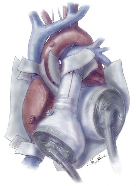 Total Artificial Heart Implantation How I Teach It The Annals Of