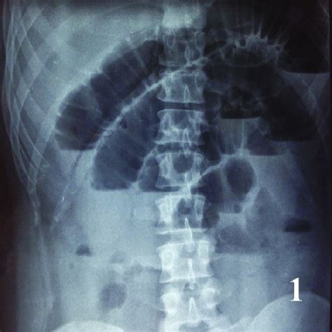 The Dilated Intestinal Loops Were With Multiple Air Fluid Levels On Download Scientific Diagram