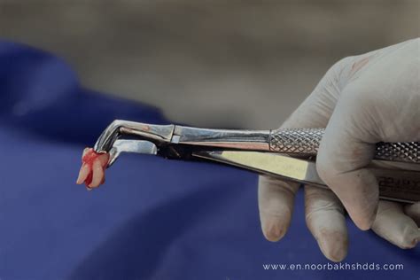 Tooth Extraction Service Dr Noorbakhsh