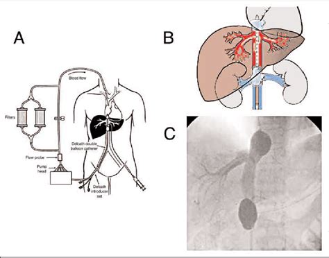 Figure 1 From The Past Decade Of Experience With Isolated Hepatic Perfusion Semantic Scholar