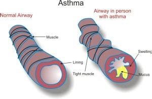 Treatment Of An Acute Asthma Attack Cognet Occupational Safety And Health