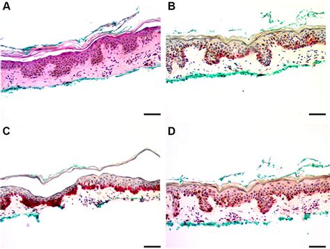 Sox 10 Hmb 45 And Melan A In Benign Melanocytic Lesions Ccid