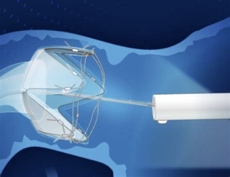 Gi Dynamics Rebrands As Morphic Medical And Reintroduces Reset Formerly The Endobarrier