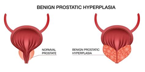 Know About Prostate Artery Embolization Bph Medfin