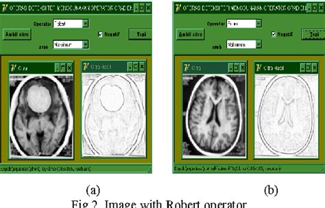 Figure 1 From Edge Detection For Brain Tumor Pattern Recognition Semantic Scholar