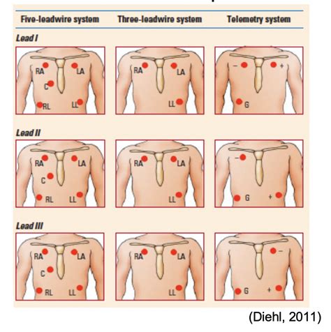 Cardiac Monitor 5 Lead Telemetry Placement