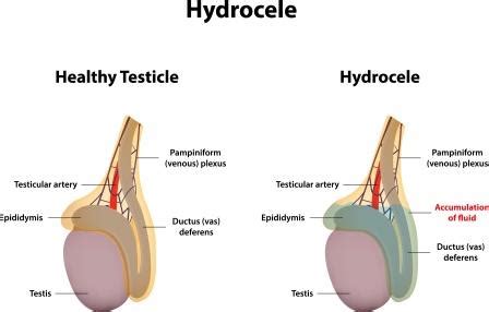 Hydrocele Testis Modern Aspect Causes Symptoms Treatment