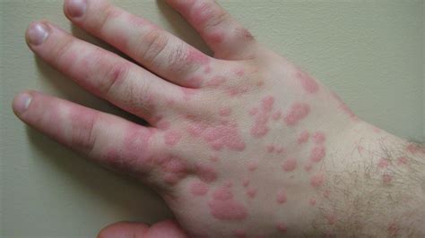 Skin Erythema