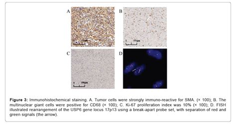 Diagnostic Pathology Open Access Large Size Intramuscular Nodular Fasciitis A Challenging