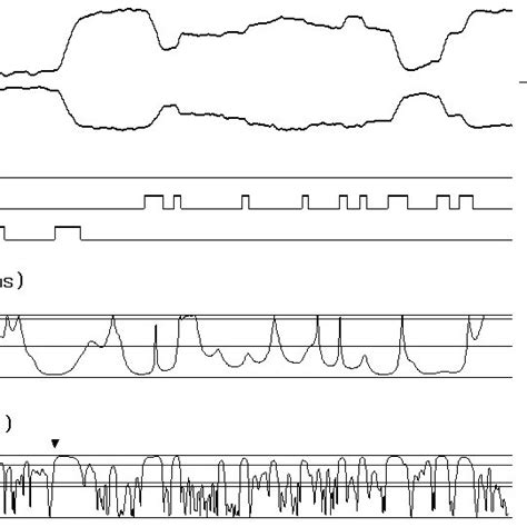 B Examples Of Automatic Detection Of Eye Movement Signals During Rem Sleep Download