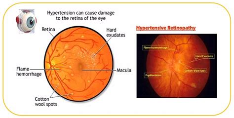 Hypertensive Retinopathy Management