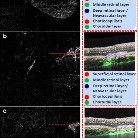 OCT At The Level Of The Choroidal Rupture With Concern For CNVM Shown Download Scientific