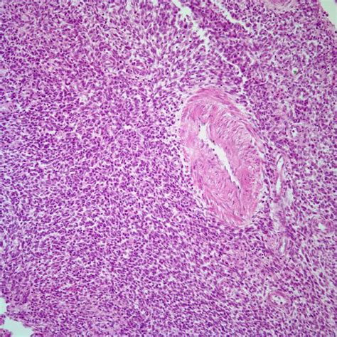 Dostarlimab Earns Priority Review From Fda In Advanced Endometrial Cancer