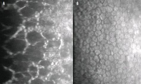 Fuchs Endothelial Dystrophy