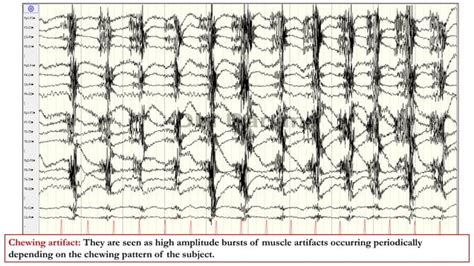 Artifacts In Eegpptx Eye And Vision Conditions Diseases And Conditions