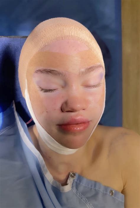 Grimes Shares Recovery Selfie After Seemingly Getting Elf Ears