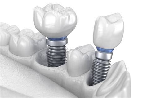 The Role Of Ti Base Abutments In Dental Implants Next Dental Lab