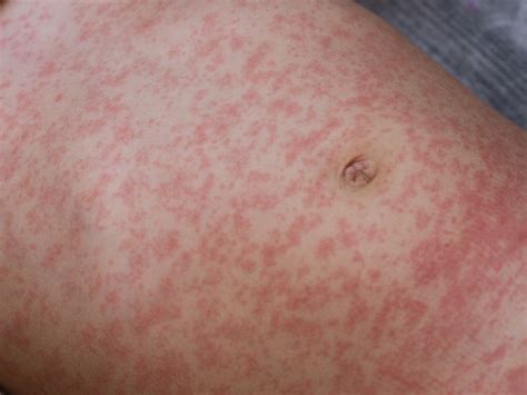 Measles Exposures Suspected At 2 Abington Healthcare Facilities Abington Pa Patch