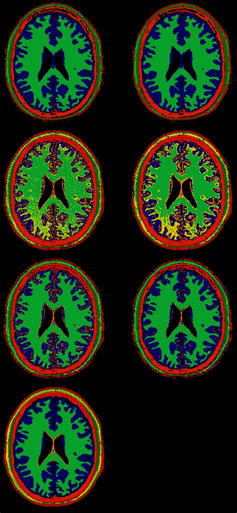 Segmentation Results With Simulated Mr Data The Three Top Left Images Download Scientific