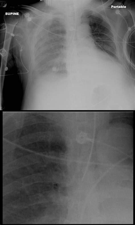 Atelectasis Chest X Ray