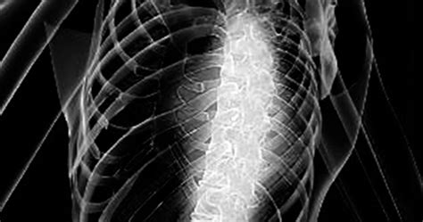 Desarrollan Un Sistema Para Mejorar La Fiabilidad De Los Implantes De Columna Vertebral