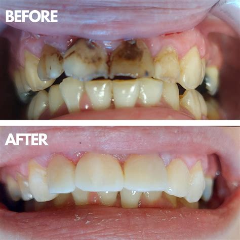 Bulimia Teeth Before And After Anorexia And Bulimia Dental Treatment