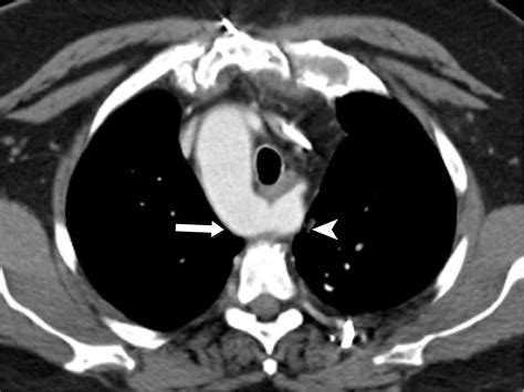 Subclavian Artery Anatomic Review And Imaging Evaluation Of