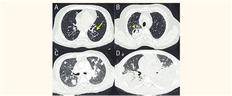 A And B Computed Tomography Ct Scan Lung Window Setting Of The Chest