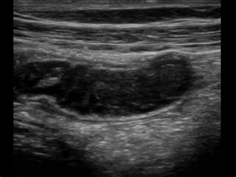 Abdomen And Retroperitoneum 1 5 Appendix Case 1 5 5 Mucocele Or Cystadenoma Of The Appendix