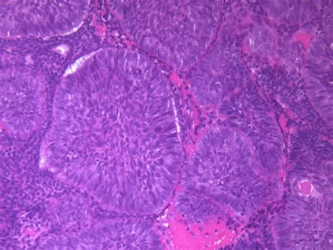 A Higher Magnified Image Of Figure 2 Showing Nests Of Basaloid Cells Download Scientific