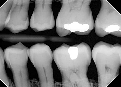 Quickray Digital X Ray Sensor Sodium Dental