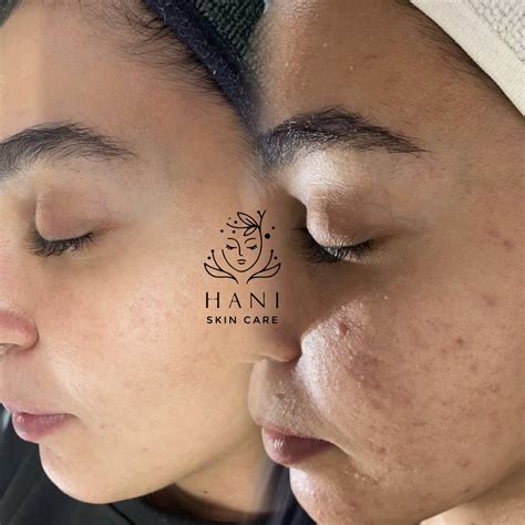 خدایاشکرت😍⚜️درمانvipجوش Haniskinclub 💚نتیجه۳جلسه درمات تخصصی جوش😍
