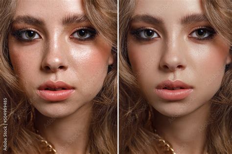 Close Up Girl With Hyperhidrosis On Her Face And Excessive Oily Sheen With Enlarged Pores And