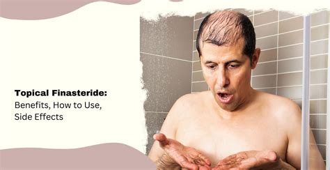 Topical Finasteride Benefits How To Use Side Effects