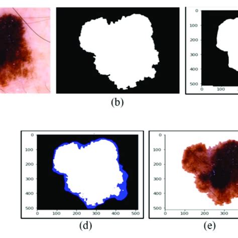 Segmentation Of The Dermoscopic Image By The Proposed Method A Download Scientific Diagram