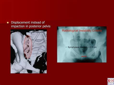 Pelvis Acetabulum Anatomy Imaging Classification Pptx