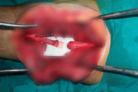 Peripheral Nerve Surgeries Dr Sushil Nahar