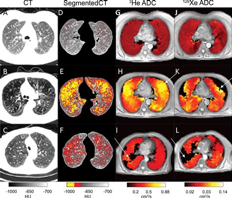 Hyperpolarized Noble Gas Ventilation Mri In Copd Radiology