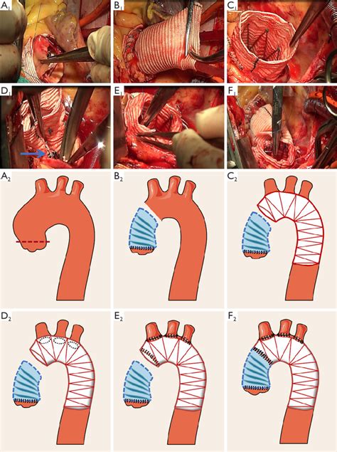 Procedure Of The Ascending Aorta Replacement And Aortic Arch Download Scientific Diagram