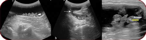 Popliteal Fossa Ultrasound Ultrasound Image Of Popliteal Fossa