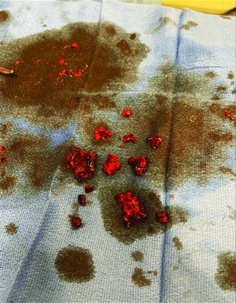 Retrieved Clots With Manual Thrombectomy Using The Flowtriever System