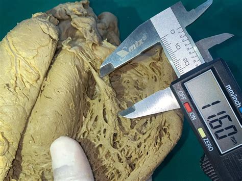 The Relationship Between Optic Nerve And Onodi Cells On Ct Scan European Journal Of Anatomy