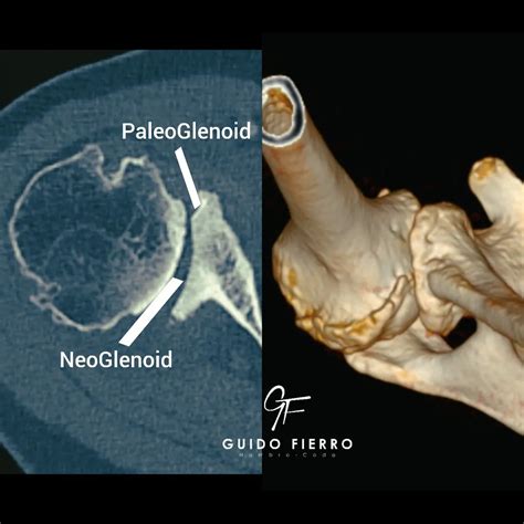 In The Walch Classification Cirugía De Hombro Y Codo