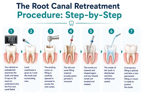 Root Canal Retreatment When You Need It And What To Expect